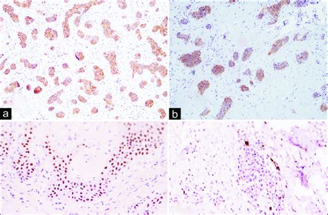 Immunohistochemical Staining Reveals That Tumor Cells Show