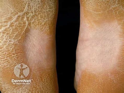 Diffuse Hereditary Palmoplantar Keratodermas