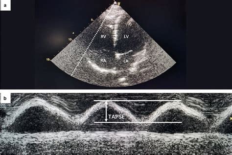 Measurement Of Tapse In M Mode Echocardiography A Tapse In Apical