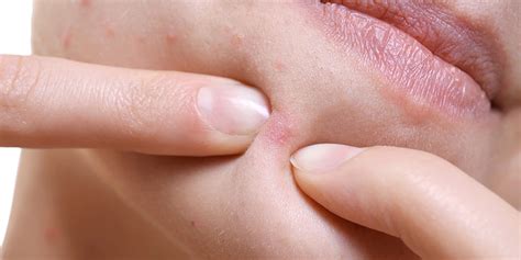 Infected Pimples Causes Symptoms And Treatments