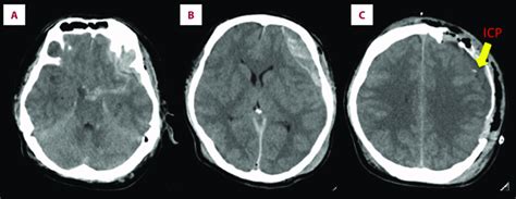Head Computed Tomography Ct Before And After Emergency Craniotomy