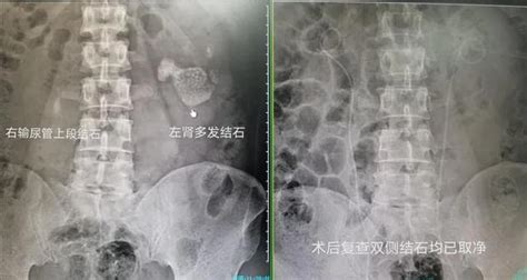 1258顆，全部從體內取出！醫生：無症狀病人很多，嚴重可危及生命 每日頭條