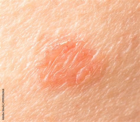Ringworm Stages