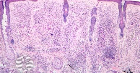 Juvenile Xanthogranuloma Image