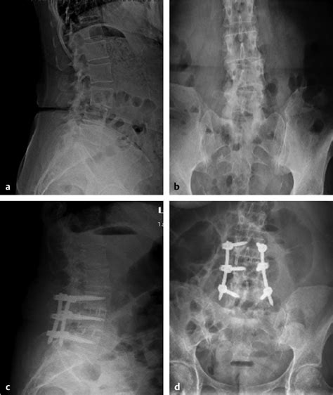 Percutaneous Pedicle Screw Placement For Spinal Instrumentation