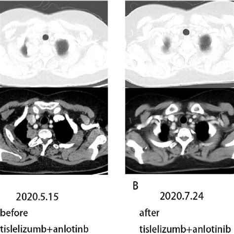 Comparison Of The Size Of Another Pleural Metastasis Before And After