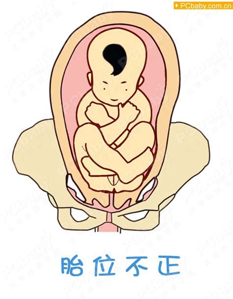 警惕胎位不正 科普图库 亲子图库 太平洋亲子网