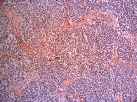 Ovary Dysgerminoma Gross