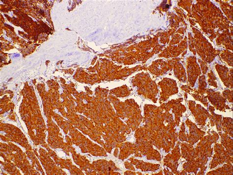 Positive Staining For Synaptophysin In Brown With Negative Staining