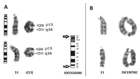 Hadayatullah On Linkedin Difference Between Ring Chromosome Vs Dicentric Ring Chromosome