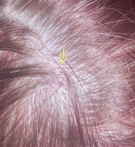 Cyst Or Something Else Scalp Help Please R Dermatologyquestions