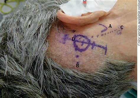 Figure 1 From Endoscopic Microvascular Decompression A Stepwise Operative Technique Semantic