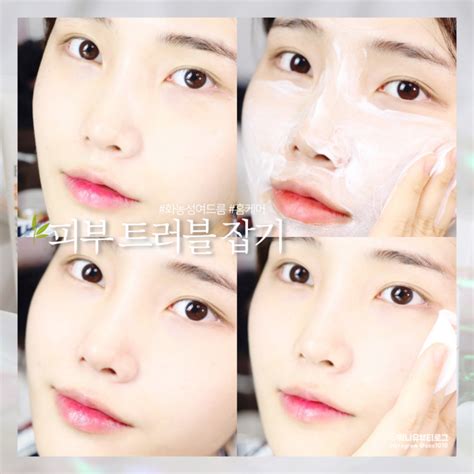화농성여드름 홈 케어가 중요해요 네이버 블로그