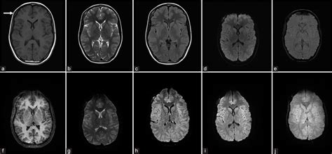 Multi Contrast Echo Planar Imaging Sequence Echo Planar Imaging Mix In Clinical Situations