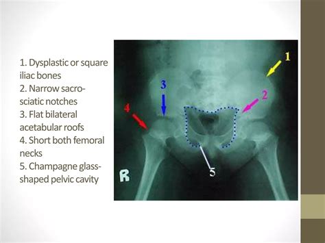 Achondroplasia Pseudochondroplasia And Hypochondroplasia Ppt