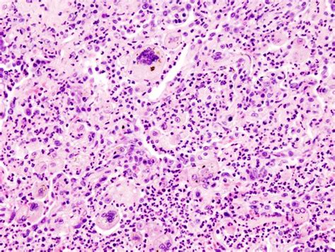 Aspiration Pneumonia Icd 10 Brenton Has Campbell