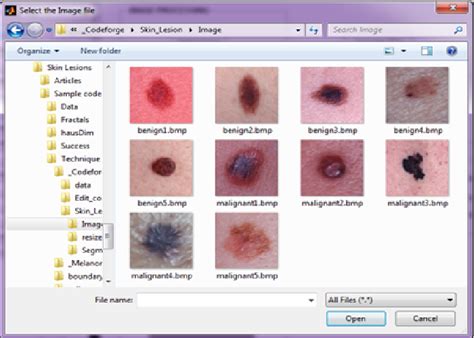 Figure 1 From Abcd Rules Segmentation On Malignant Tumor And Benign Skin Lesion Images