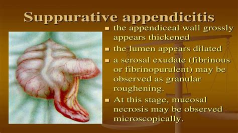 Classification Of Acute Appendicitis Pptx