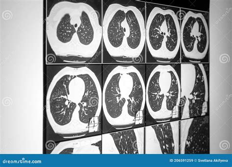 Mri Computed Tomography Of The Lungs Check The Lungs In The Hospital