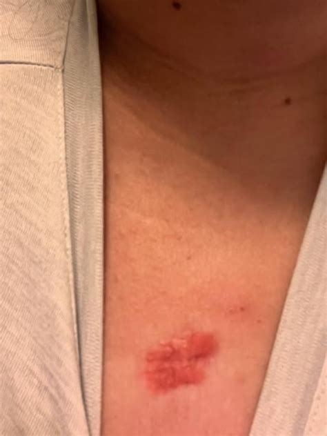 Chest Keloid Eclar Plaster Update Rkeloids