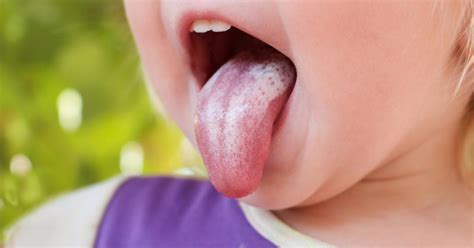 Oral Thrush Home Remedies