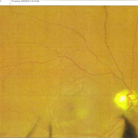 Fundus Left Eye Optic Atrophy Narrow Vessels No Macular Reflex