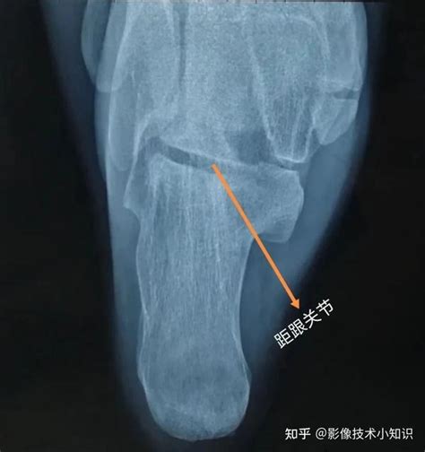如何拍出标准的跟骨轴位片 知乎
