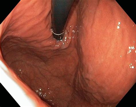 Normal Stomach Endoscopy
