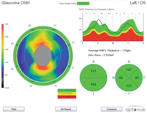 Oct In Glaucoma Diagnosis Detection And Screening Intechopen