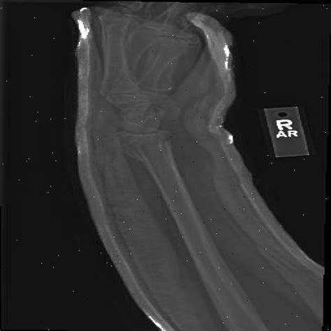 Xray Fracture Object Detection Dataset V Am By Wkspaceone