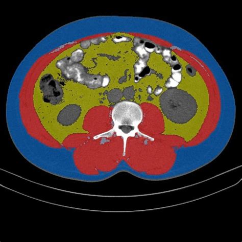 Compartment Of BMI And L3 SMI Presence Of Sarcopenia In Patients With