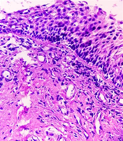 Premium Photo Histology Of Urachal Cyst Photomicrograph Of