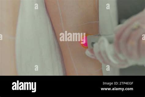 Close Up Footage Of A Female Clients Leg Receiving Pulses Of Laser