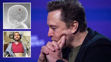Elon Musks Neuralink Chip Suffers Unexpected Setback In First Inhuman Brain Implant Daily
