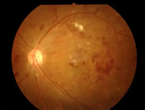 Diabetic Retinopathy Europe American Academy Of Ophthalmology