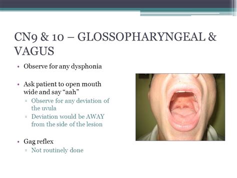 Uvula Deviation