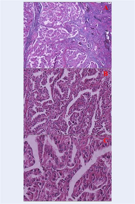 Microscopic Appearance Of Papillary Renal Cell Carcinoma Papillae With