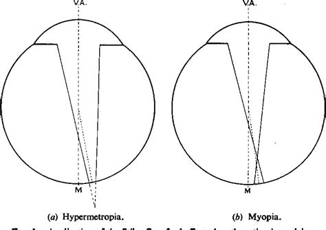 Figure 3 From Communications The Accommodation Reflex And Its Stimulus