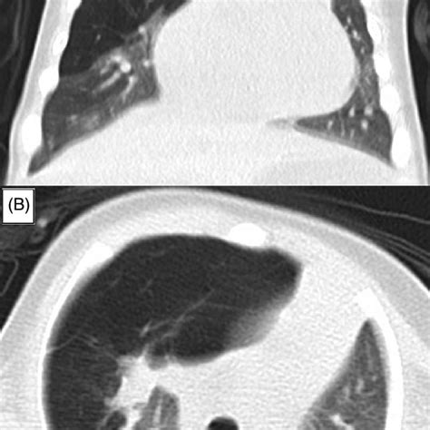 Preoperative Computed Tomography A Transverse Plane B Coronal