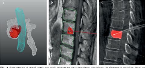 Figure 2 From Spinal Metastases Segmentation In Mr Imaging Using Deep