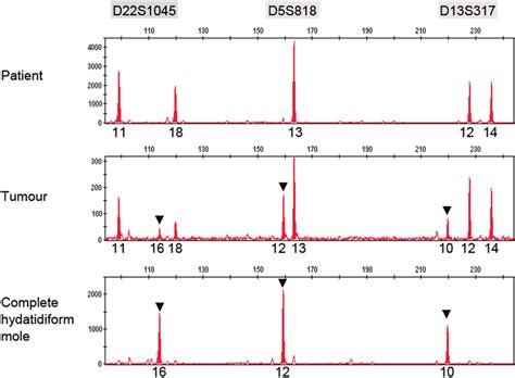 short tandem repeat genotyping of the patient her tumor and complete