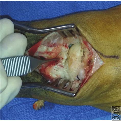 Intraoperative Photograph Showing The Fragmented And Avascular Download Scientific Diagram
