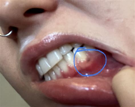 Something Stuck Deep In Gums How Do I Remove R Askdentists