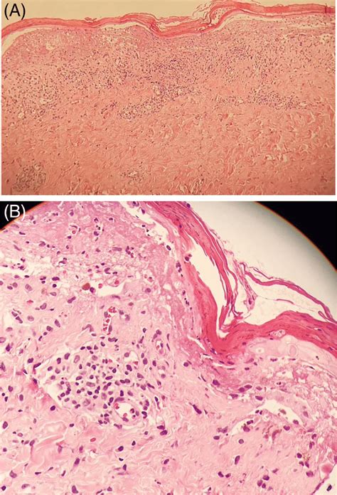 Vacuolar Interface Dermatitis With Confluent Extensive Epidermal Cell