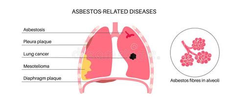 Asbestos Related Diseases Stock Vector Illustration Of Atelectasis