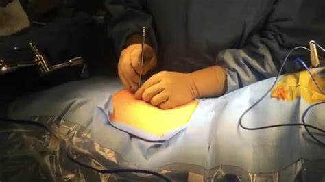 Minimally Invasive Microdiscectomy L5 S1 Youtube