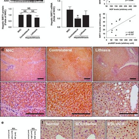 expression of sirt1 in human hepatolithiasis and mouse cholestatic