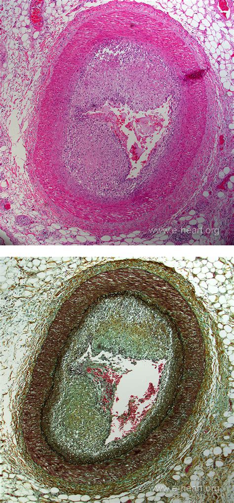 E Cardiovascular Pathology Home Page