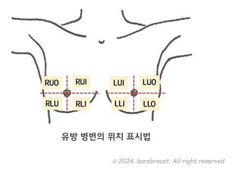 유방 검사 판독지 해석 예시와 함께 유방 검사 및 질환 유방암 바로알기