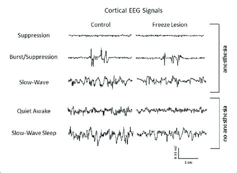 Representative Intracranial Electroencephalogram Eeg Recordings Download Scientific Diagram